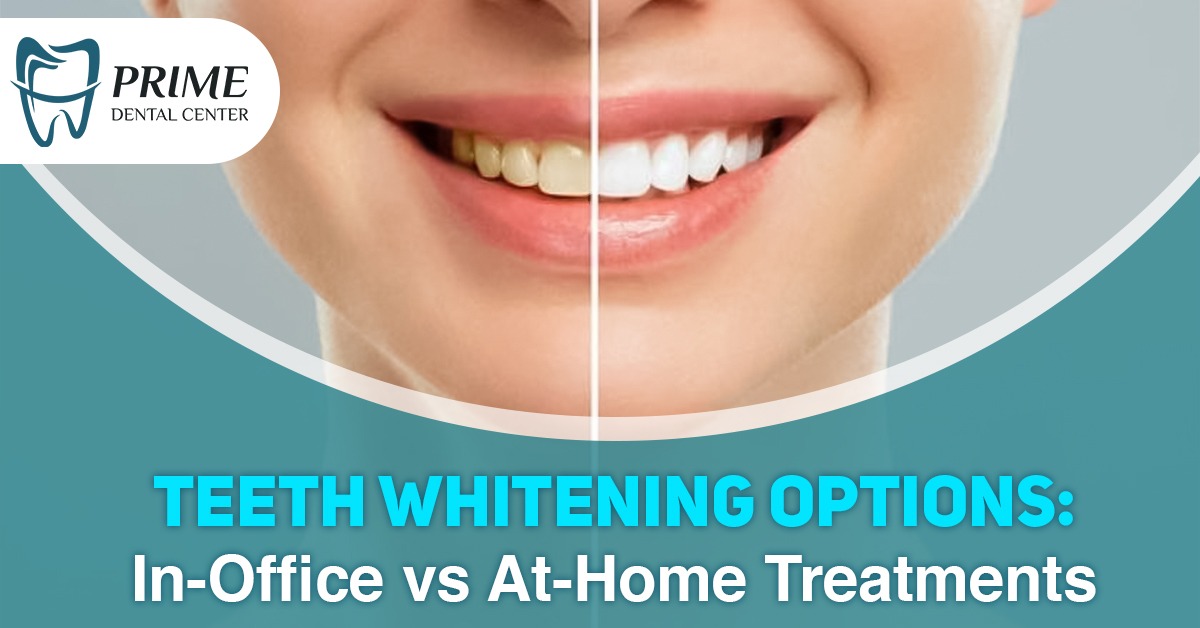 Professional & At-Home Teeth Whitening | Prime Dental Center - Prime ...