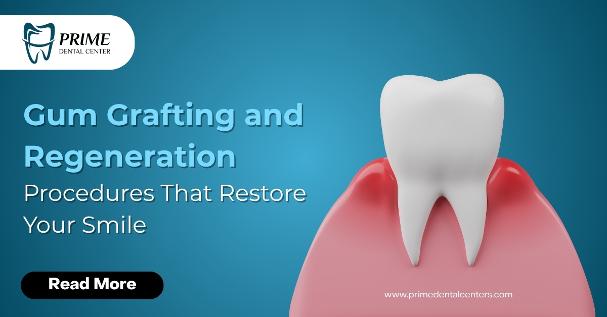 Gum Grafting & Regeneration | Restore Your Smile at Prime Dental Center